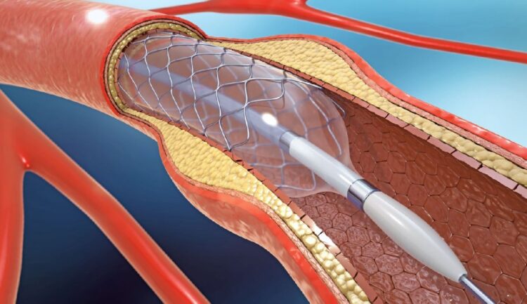 Anjiyo Nedir? Balon Ve Stent İşlemi Nasıl Uygulanır? - MaksatBilgi